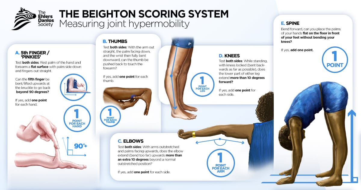 Hypermobility and Physiotherapy | The Brisbane Spine Clinic Hypermobility and Physiotherapy | The Brisbane Spine Clinic